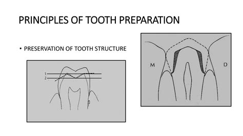 Principles Of Tooth Preparationpptx