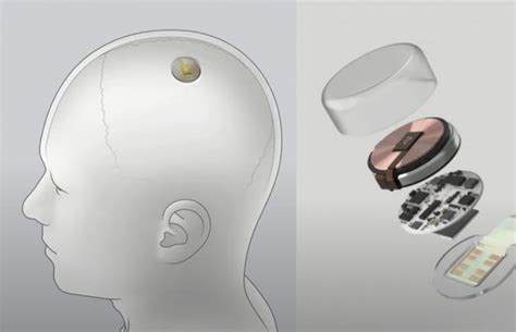 Hazte A Un Lado Black Mirror El Chip Cerebral De Elon Musk Es Casi Una