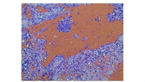 Histopathology Of The Biopsy Specimen Showing Spindle Shaped Cells With Download Scientific