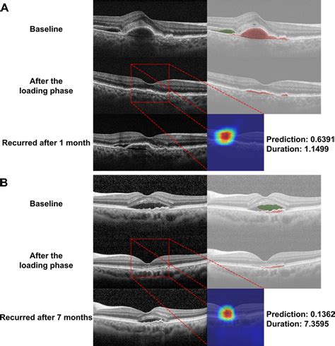 Representative Cases Of Neovascular Age Related Macular Degeneration Download Scientific
