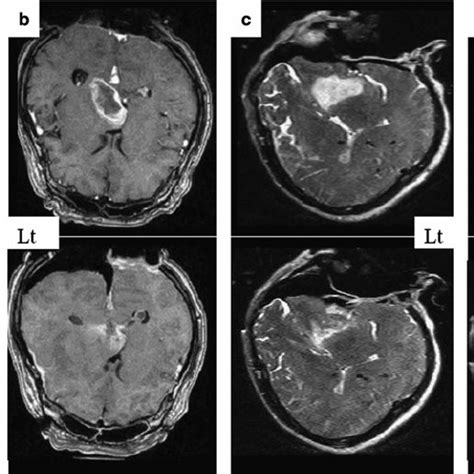 Results Of Information Guided Surgery For Glioma Using 03 T