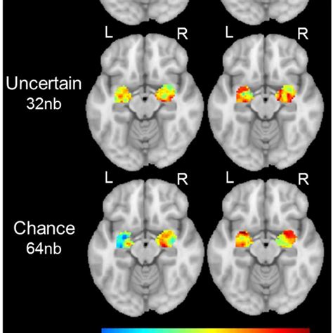 Sex Difference In Resolving Uncertain Emotion Combined Amygdala Sex