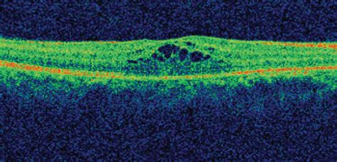A L Serial Oct Scans Showing The Evolution Of Maculopathy Obtained