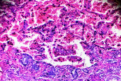 Hypersensitivity Pneumonitis Prevalence In An Insured Us Population Pulmonology Advisor