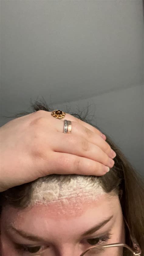 Severe Scalp Plaque Psoriasis Rmakemesuffer