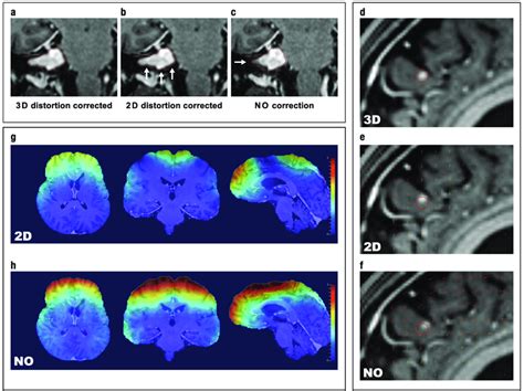 4 Impact Of Gradient Nonlinearity Distortion Correction A C Example Download Scientific