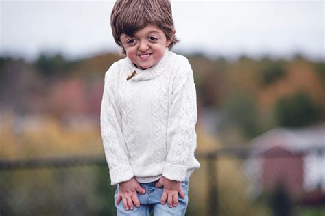 Weathering The Storm Of Apert Syndrome Joãos Story