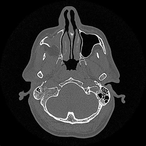 Maxillary Sinus Atelectasis Pacs
