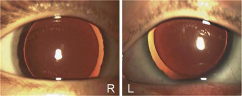 Anterior Segment Aspect Observed In The 2 Years Old Patient Carrying