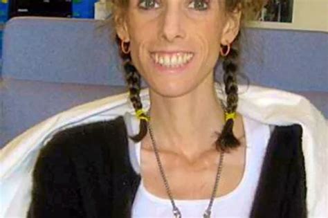 My Anorexic Hell Then Obese Nightmare And How I Achieved A Healthy Body