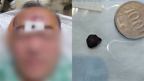 의사가 돌 박힌 상태로 봉합이마에 돌 들어간 남성 사연