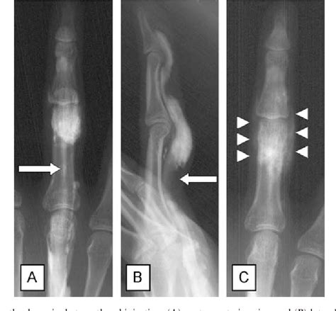 Figure 1 From Single Injection Digital Block Is A Transthecal Injection Necessary Semantic