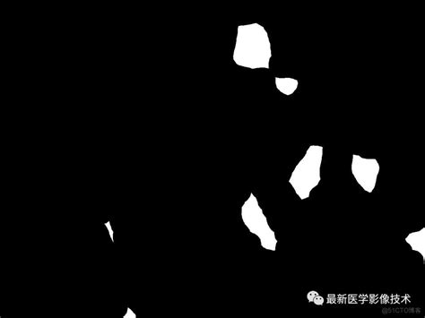 医学图像处理案例（三）——用分水岭算法分割重叠细胞 51cto博客 分水岭图像分割