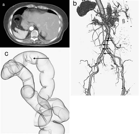 Figure 1 From Laparoscopic Sigmoidectomy For A Patient With Situs Inversus Totalis Effect Of