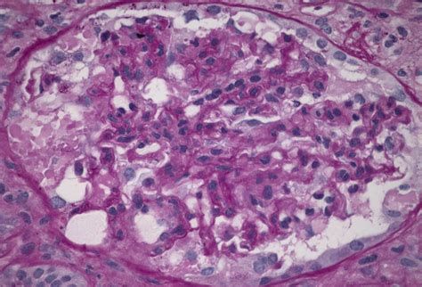 Dual Glomerular Lesion In Hiv Patient Auctores