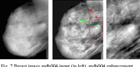 Figure 2 From Textural Approach For Mass Abnormality Segmentation In Mammographic Images