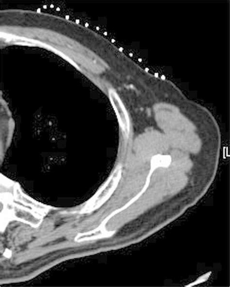 Clear Visualization Of The Direct Connection Between Sentinel Lymph