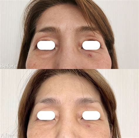 世界初の液体状pcl「gouri ゴウリ」登場 京都市伏見区の美容皮膚科 山本クリニック ソフトメディ