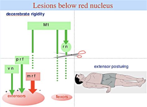 Decorticate Posturing Red Nucleus