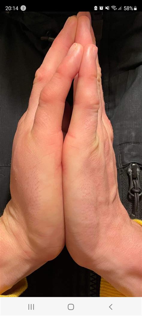 So Im Pretty Sure Ive Broken My 5th Metacarpal Neck However I Literally Cannot Afford To Have