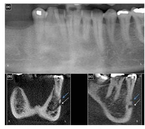 Mental Foramen Semantic Scholar