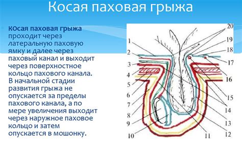 Паховая грыжа у девочек причины симптомы диагностика классификация операция открытый
