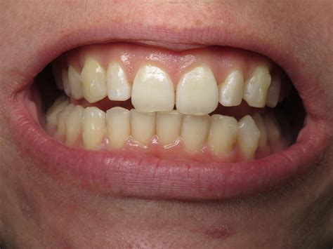 What Do Invisalign Buttons Look Like Seasons Of Smiles