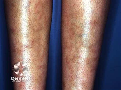 Cutaneous Lupus Erythematosus