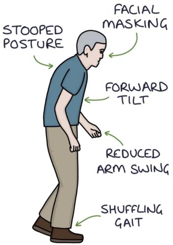 Neurogenetic Disorders Flashcards Quizlet