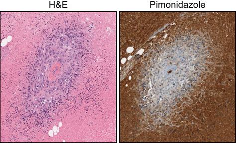 Drug Resistance And Cellular Adaptation To Tumor Acidic Ph