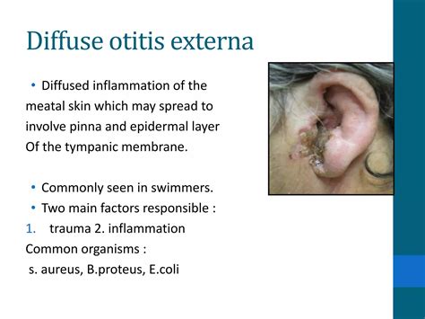 Diseases Of External Ear Pptx