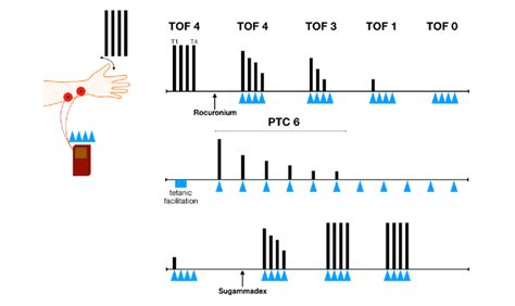 Neuromuscular Monitoring Ptc Post Tetanic Count Tof Train Of Four Download Scientific Diagram