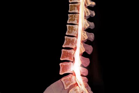 Bulgingherniated Disc Archives Spinal Backrack