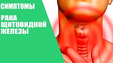 Симптомы рака щитовидной железы Youtube