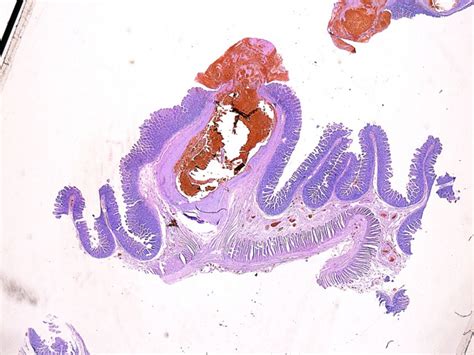 Pathology Specimen Showing Dieulafoys Lesion In The Small Bowel