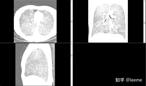 C Dicom多平面重建mpr算法 知乎