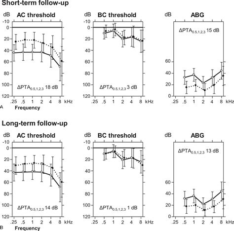 Hearing Results Of Surgery For Acquired Atresia Of The Exter Otology And Neurotology