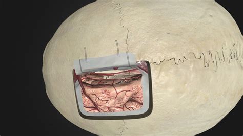 Interhemispheric Craniotomy 3d Models The Neurosurgical Atlas