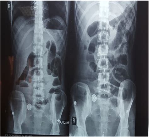 Dilated Small Bowel Loops Multiple Air Fluid Levels With The Absence Of Download Scientific