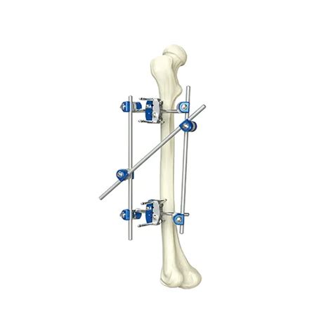 Orthopaedic External Fixation Device Ulna And Radius External Fixator For Wrist Fractures Wrist