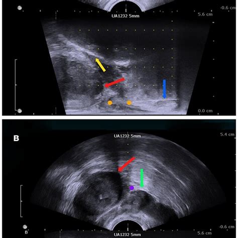Diagram Of The Location Of The Perineal Nerve Block The 2 Grey Dots Download Scientific