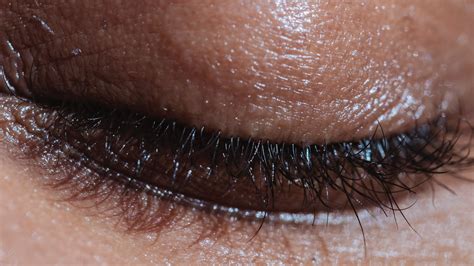 What Is Photosensitivity Cause And Treatment Skin Solution 1o1 By Pampa Roy Feb 2024 Medium