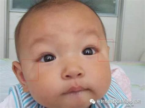 孩子这些症状警惕患有蛔虫病