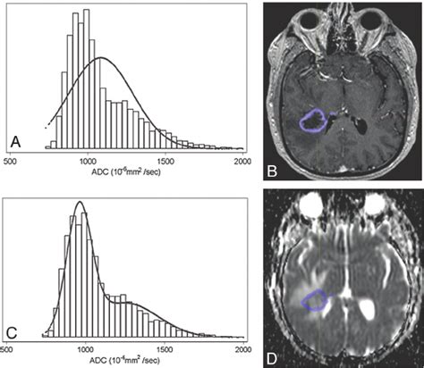 Adc Histogram And Curve Fitting Generated From Enhancing Tumor Volume Download Scientific