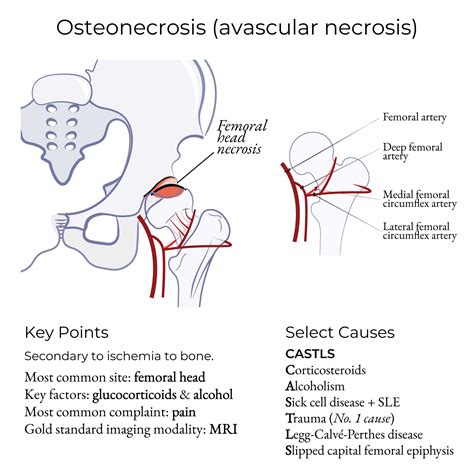 Avascular Necrosis Osteonecrosis Symptoms Causes