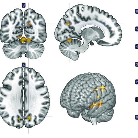 Statistical Non Parametric Map Of Significant Clusters Correlating To