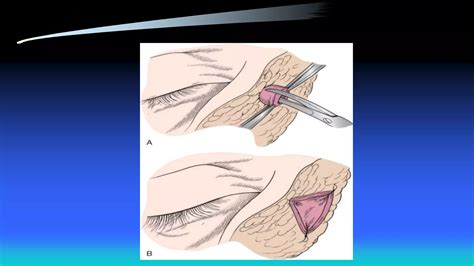 Maxillectomy And Craniofacial Resection Pptx