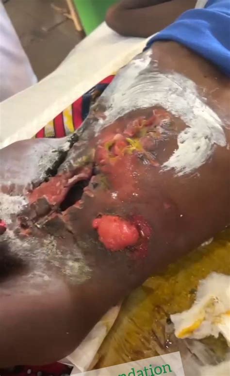 335197 Ruptured Appendix Financial Support