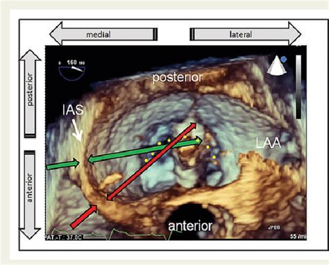 Figure 5 From Peri Interventional Echo Assessment For The Mitraclip Procedure Semantic Scholar
