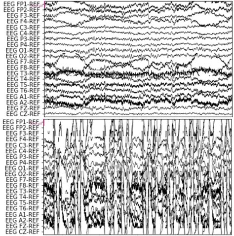 Ten Seconds Eeg Sample Of Normal Eeg Top Seizure Eeg Bottom Download Scientific Diagram